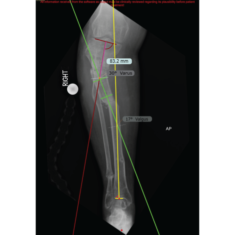 TAYLOR SPATIAL FRAME External Fixator