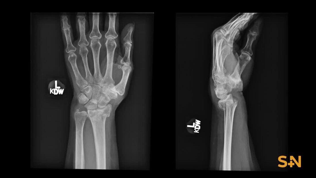 Radiología De Fracturas De Smith