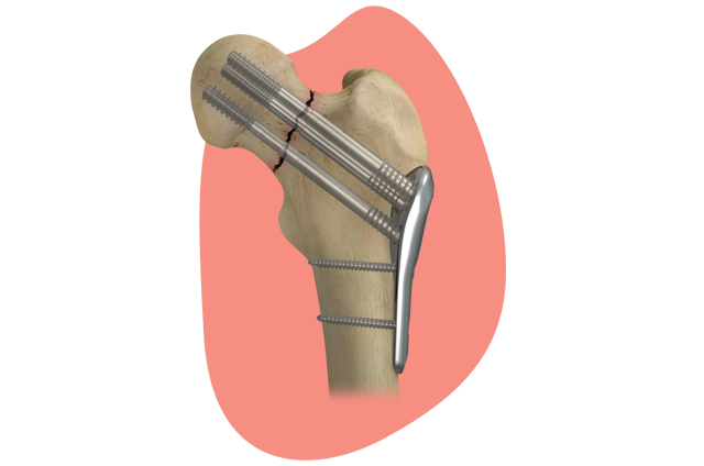 CONQUEST FN Femoral Neck Fracture System