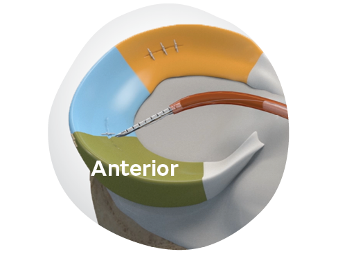 FAST-FIX FLEX Meniscal Repair System | Smith+Nephew USA