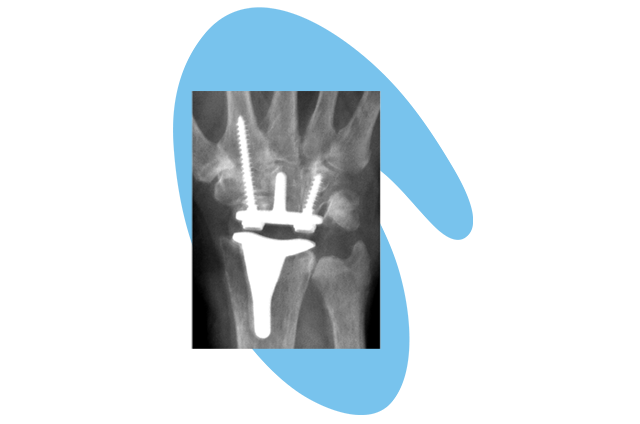 FREEDOM Wrist Arthroplasty System