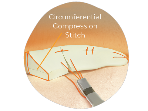 NOVOSTITCH PRO Meniscal Repair System | Smith+Nephew Australia