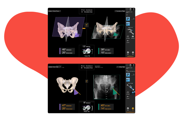 RI.HIP NAVIGATION Total Hip Arthroplasty | Smith+Nephew New Zealand