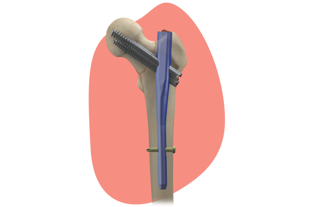 TRIGEN INTERTAN Intertrochanteric Antegrade Nail